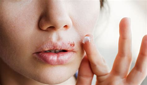 Genital Herpes Symptoms Helpful Prevention And Treatment