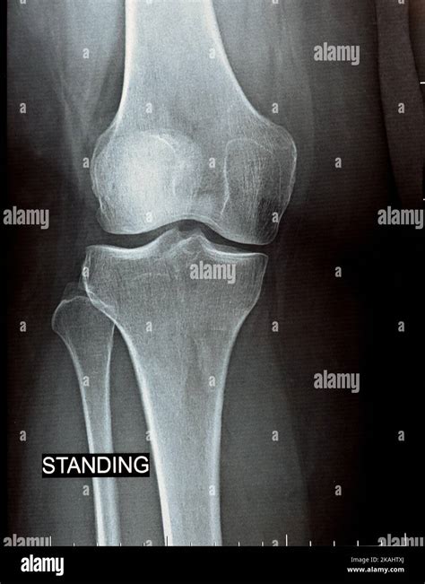 Plain X Ray On Knee Joint Showing Joint Space Narrowing And Subchondral Sclerosis On Medial