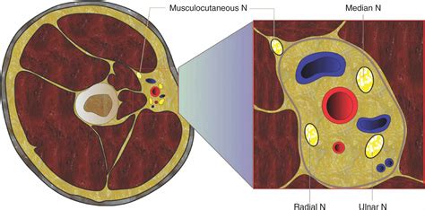 Axillary Brachial Plexus Block Anesthesia Key