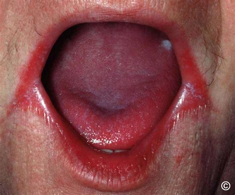 Infectious Cheilitis