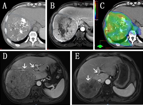 Phase 1 Trial Of Apatinib Combined With Intensity Modulated
