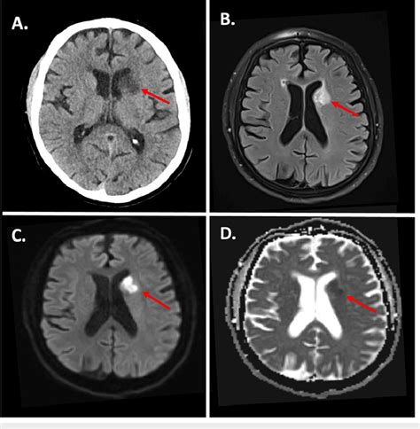 Ct And Mri Following Left Caudate Nucleus Stroke A Ct Head Showing Download Scientific Diagram