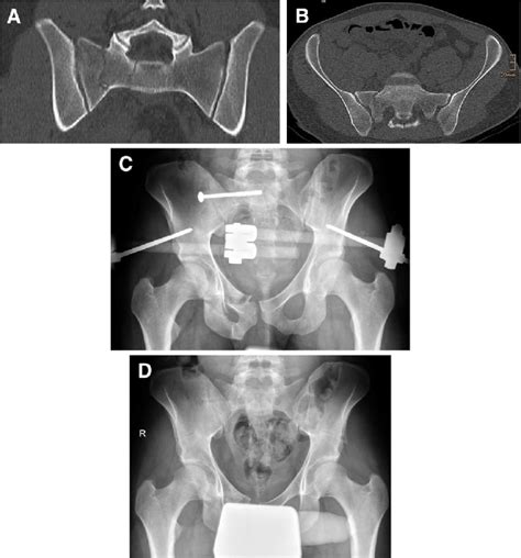 Clinical Example For Operative Therapy Of A Lateral Compression Download Scientific Diagram