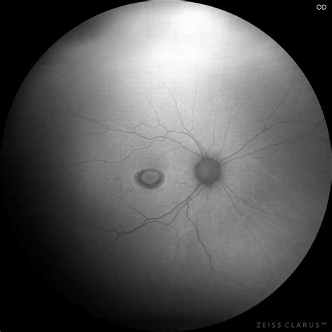 Bulls Eye Maculopathy Related To Antimalarial Drugs Retinography