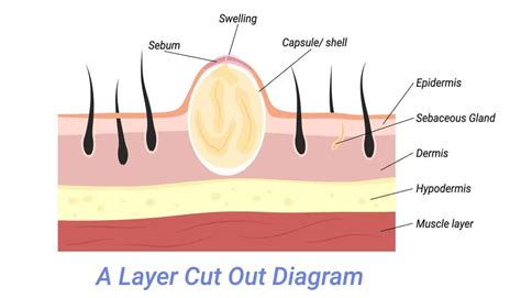 Popping A Sebaceous Cyst Can I Burst A Sebaceous Cyst At Home