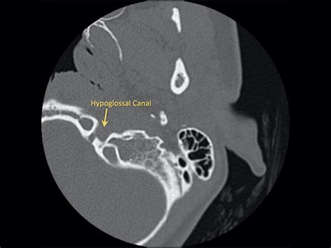 Normal Temporal Bone CT With Annotated Images Radiopaedia