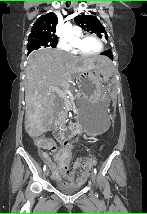 Carcinomatosis With Widespread Metastatic Colon Cancer