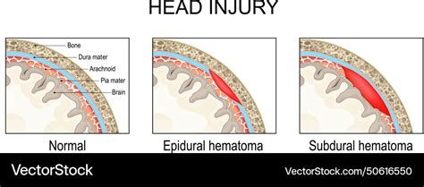 Epidural Hematoma And Subdural Traumatic Vector Image