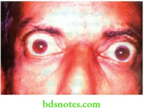 Hyperthyroidism Signs Causes And Treatment Bds Notes