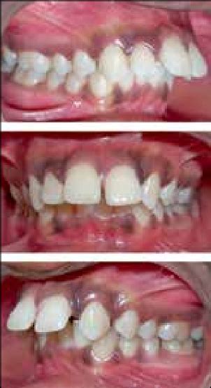 Showing Angles Class Ii Division 1 Malocclusion With Large Overjet And