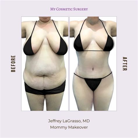 Jeffrey Lagrasso Md Mommy Makeover My Cosmetic Surgery