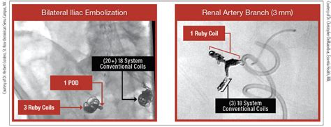 Ruby® Coil And Pod® System A Coil Platform For Fast And Easy Embolization Endovascular Today