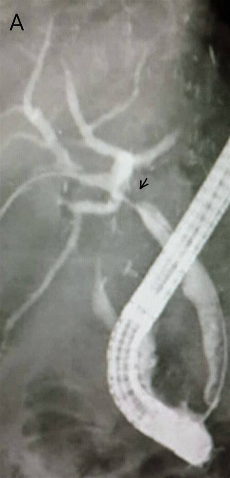 Ercp And Egd Fourth Follow Up Ercp For Post Lover Transplant