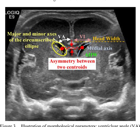 Figure 3 From Cranial Ultrasound Based Prediction Of Post Hemorrhagic
