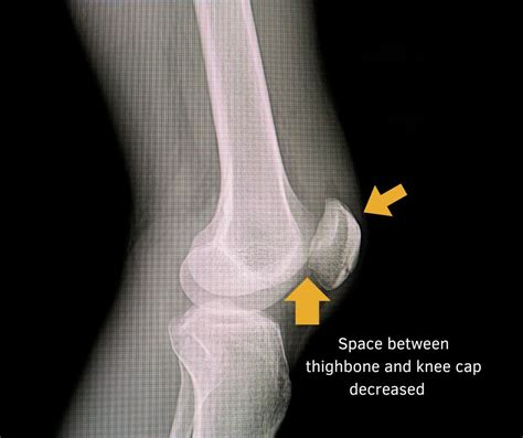 X Ray Knee Patellar Tendonitis At Loretta Sams Blog