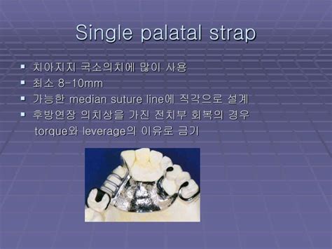 Ppt 상악 Rpd 설계 Powerpoint Presentation Id 882425