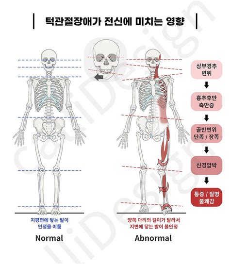 의학그림 메디컬 일러스트 Callidesign On Instagram 턱관절 장애가 전신에 미치는 영향 설명하는 메디컬일러스트 입니다 프로필 링크 주소 Ctee