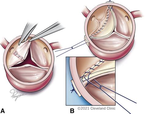 Symmetric The American Association For Thoracic Surgery Aats