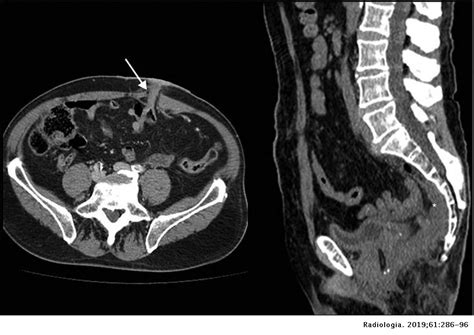 Tomografía Computarizada Multidetector Urgente De La Cirugía Del Cáncer Colorrectal Cambios