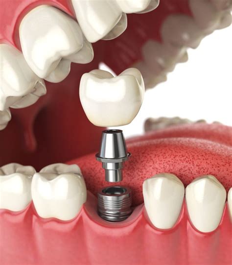 Implant Dentaire Titane à Paris 10 Clinique Dentaire Lafayette