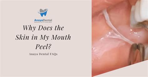 Why Does The Skin In My Mouth Peel Anaya Dental