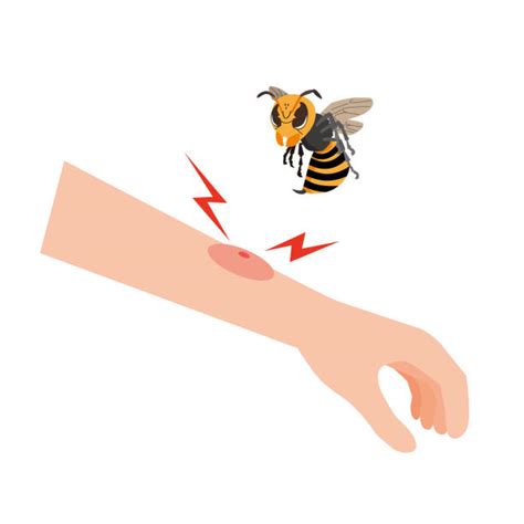 400 Choc Anaphylactique Stock Illustrations Graphiques Vectoriels