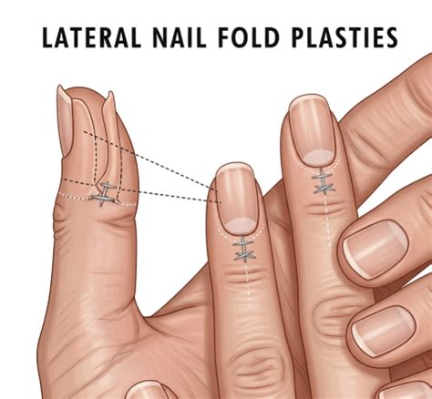 Lateral Nail Fold Plasties In Korea Koreahealthglobal