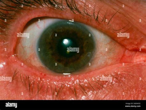 Kayser Fleischer Ring A Brownish Ring Overlying The Outer Rim Of The Iris Of The Eye When Well