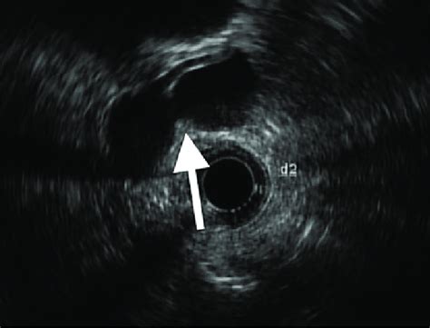 Endoscopic Ultrasound Revealing A 1 5 Cm Sessile Polypoid Lesion In The Download Scientific
