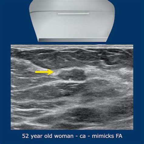 The Radiology Assistant Ultrasound Of The Breast