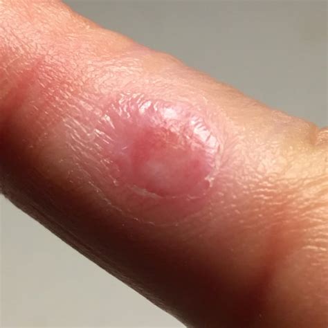 This Look Like A Deep Wart Any Suggestions Rwarts