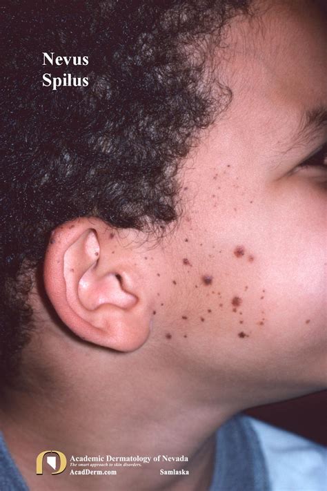 Nevus Spilus Speckled Lentiginous Nevus Academic Dermatology Of Nevada