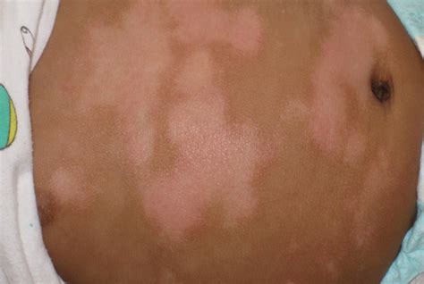 Hyper Or Hypo Pigmented Lesions Pediatric Dermatology