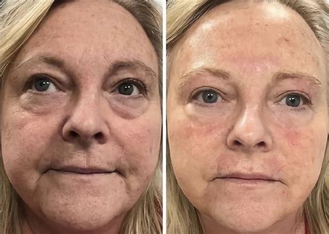 Hydrafacial Before And After Real Photos And Simple Steps