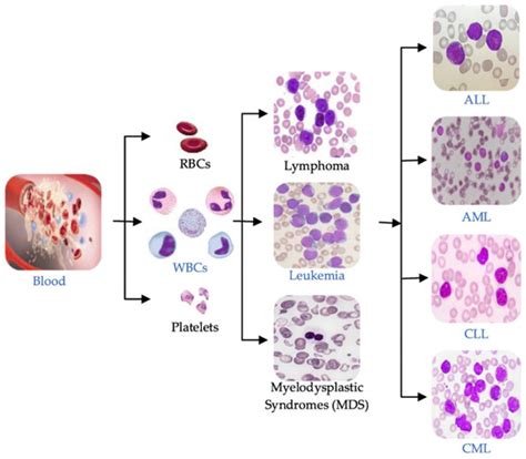 A Review Of Deep Learning Techniques For Leukemia Cancer Classification