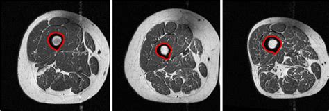 Results Of The Femur Segmentation Algorithm For Three Different