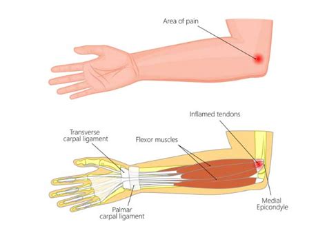 Medial Epicondylitis Golfers Elbow Flexor Mass Tendon Tear