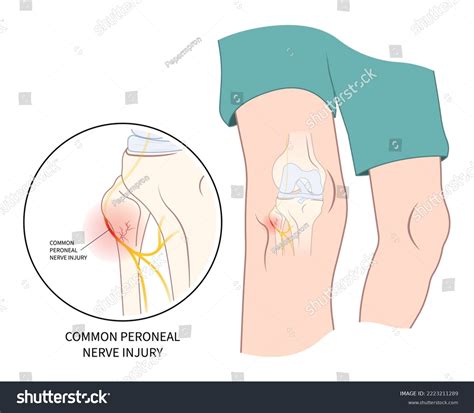Common Fibular Nerve