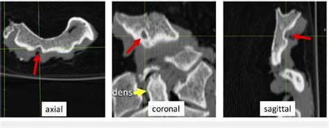 Cross Section Computed Tomography Ct Of The Fossa Navicularis Red Download Scientific