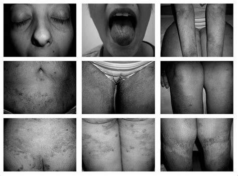 Female Patient With Acrodermatitis Enteropathica Following Bariatric