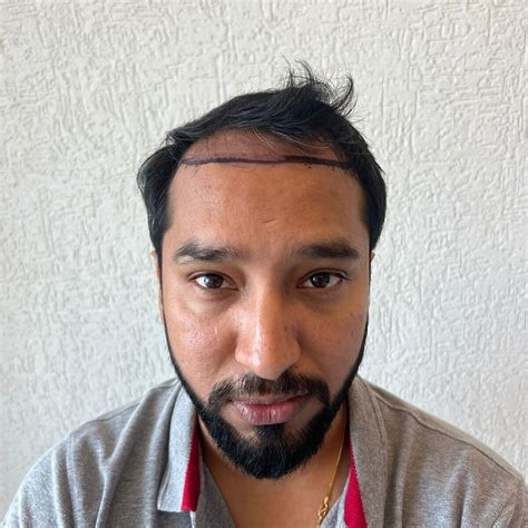 Norwood Scale Male Pattern Baldness Stages Assure Clinic