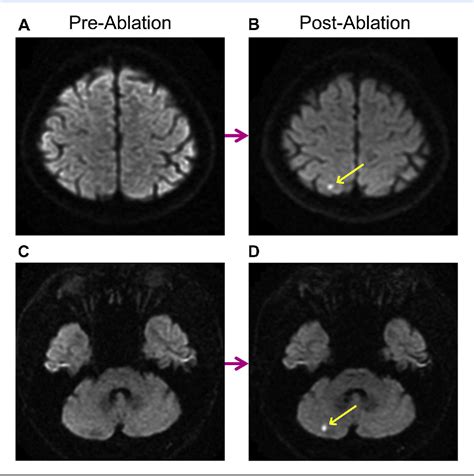 Figure 1 From Asymptomatic Cerebral Infarction During Catheter Ablation For Atrial Fibrillation