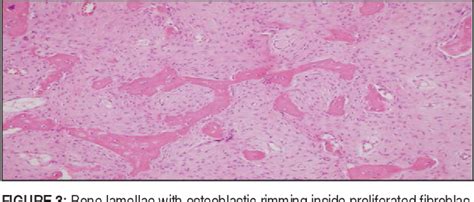 Figure 3 From Peripheral Ossifying Fibroma In Maxillary Bone Semantic Scholar