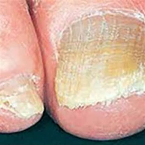 Fungal Nail Treatment Lyte Laser Clinic