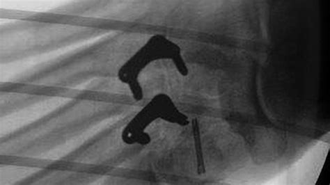Ratcheting Compression Plating System Acumed
