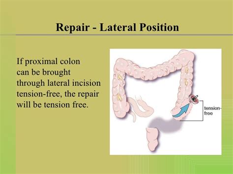 Laparoscopic Sigmoid Colon Resection Supine And Lateral