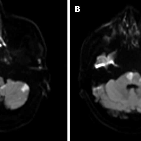 The Results Of Diffusion Weighted Imaging In Patients With Brain