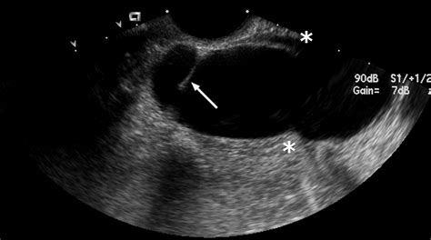Linear Ultrasound Hydrosalpinx