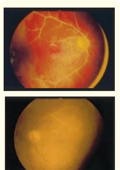 Bilateral Retinal Arteriolar Calcification Photo Courtesy Of Martin