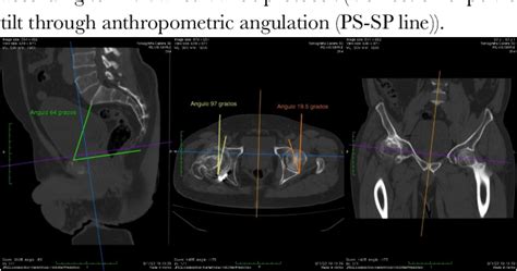 Figure 6 From Acetabular Version Angle Measurement In 3d Vs 2d Models Using Computed Tomography